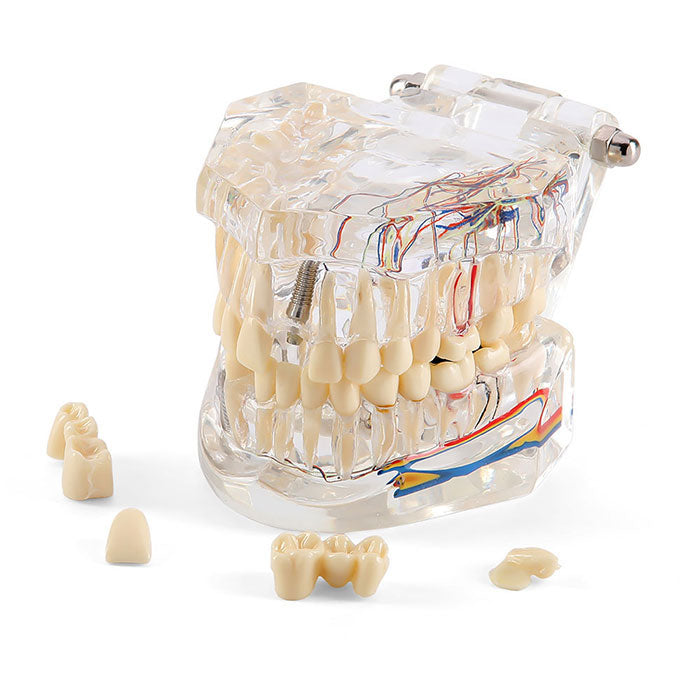 Dental Oral Typodont Model Implant Pathological Removable Teach Demo T ...