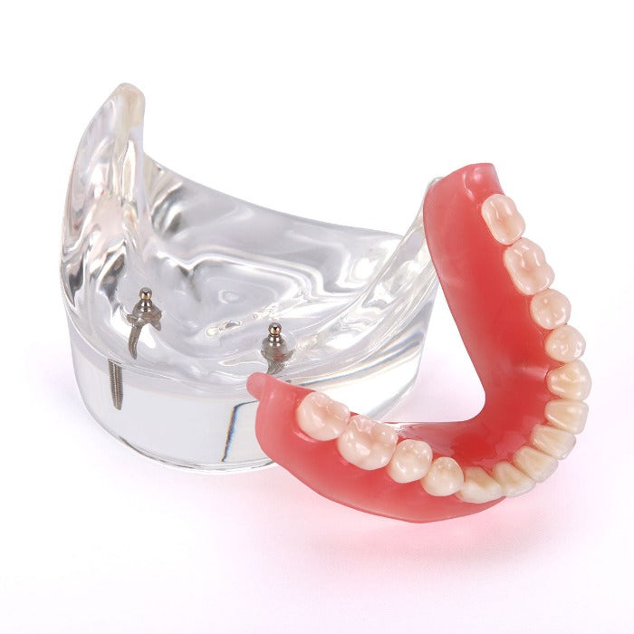 Dental Implant Teeth Model Demo Overdenture Restoration With 2 Implant ...